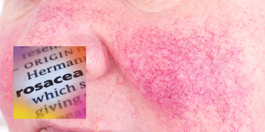 Rosacea Nhs